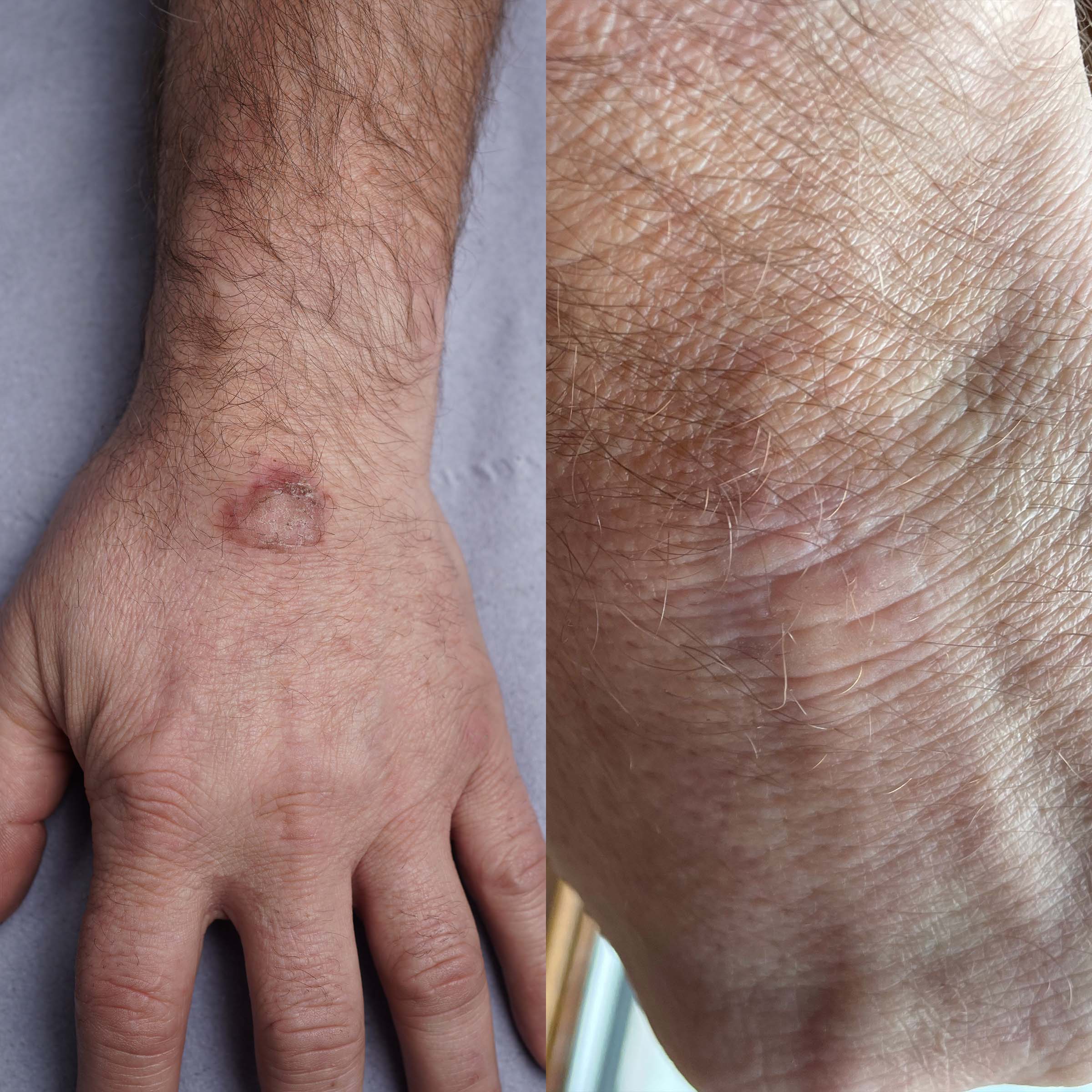Before & After Pictures of treatments performed at Highland Laser Clinic