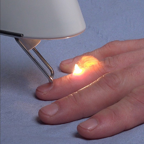 Highland Laser Clinic: Laser Treatment for Warts and Verrucas